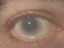 LCAT deficiency : LearnYourLipids