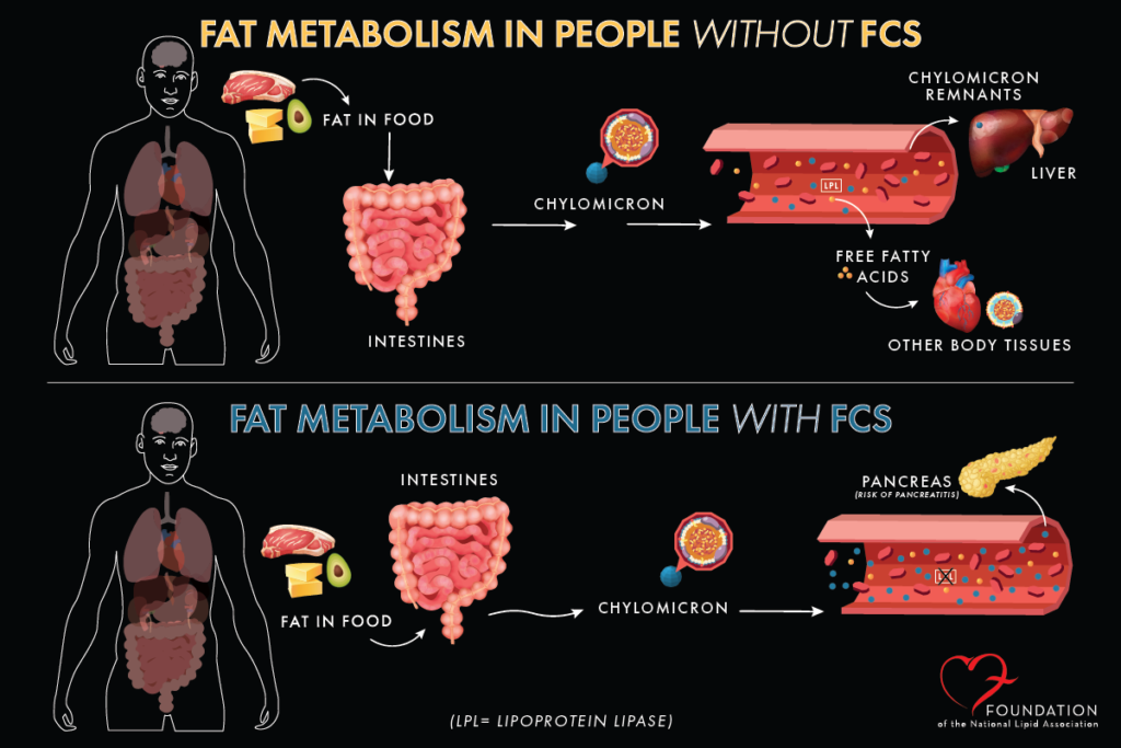 Familial Chylomicronemia Syndrome : LearnYourLipids